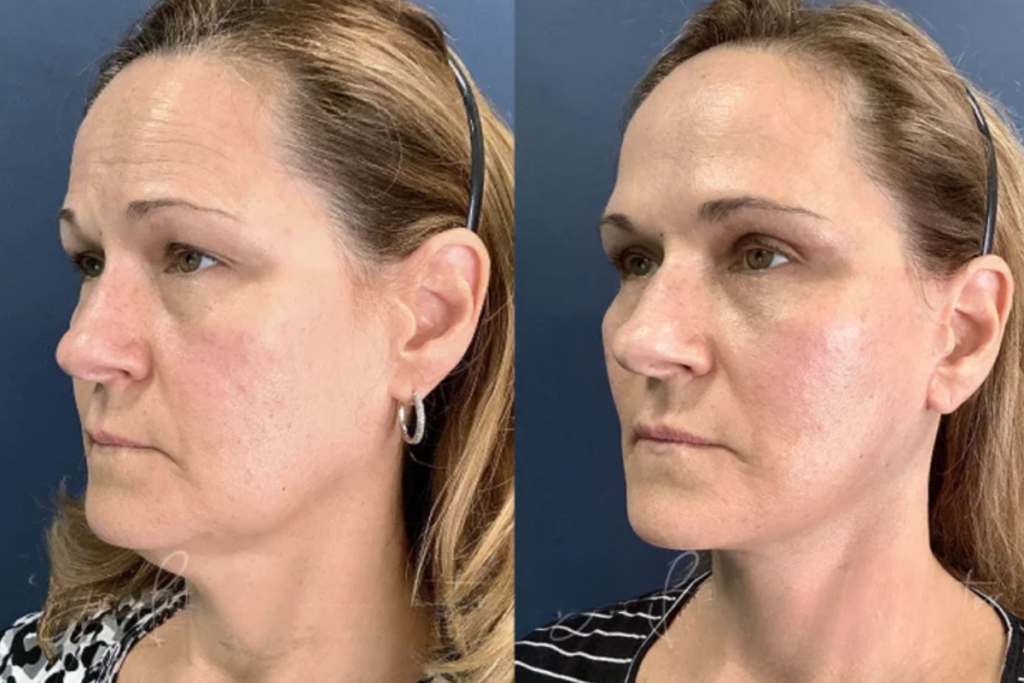 How to Safely Lose Weight for Visible Face Transformations